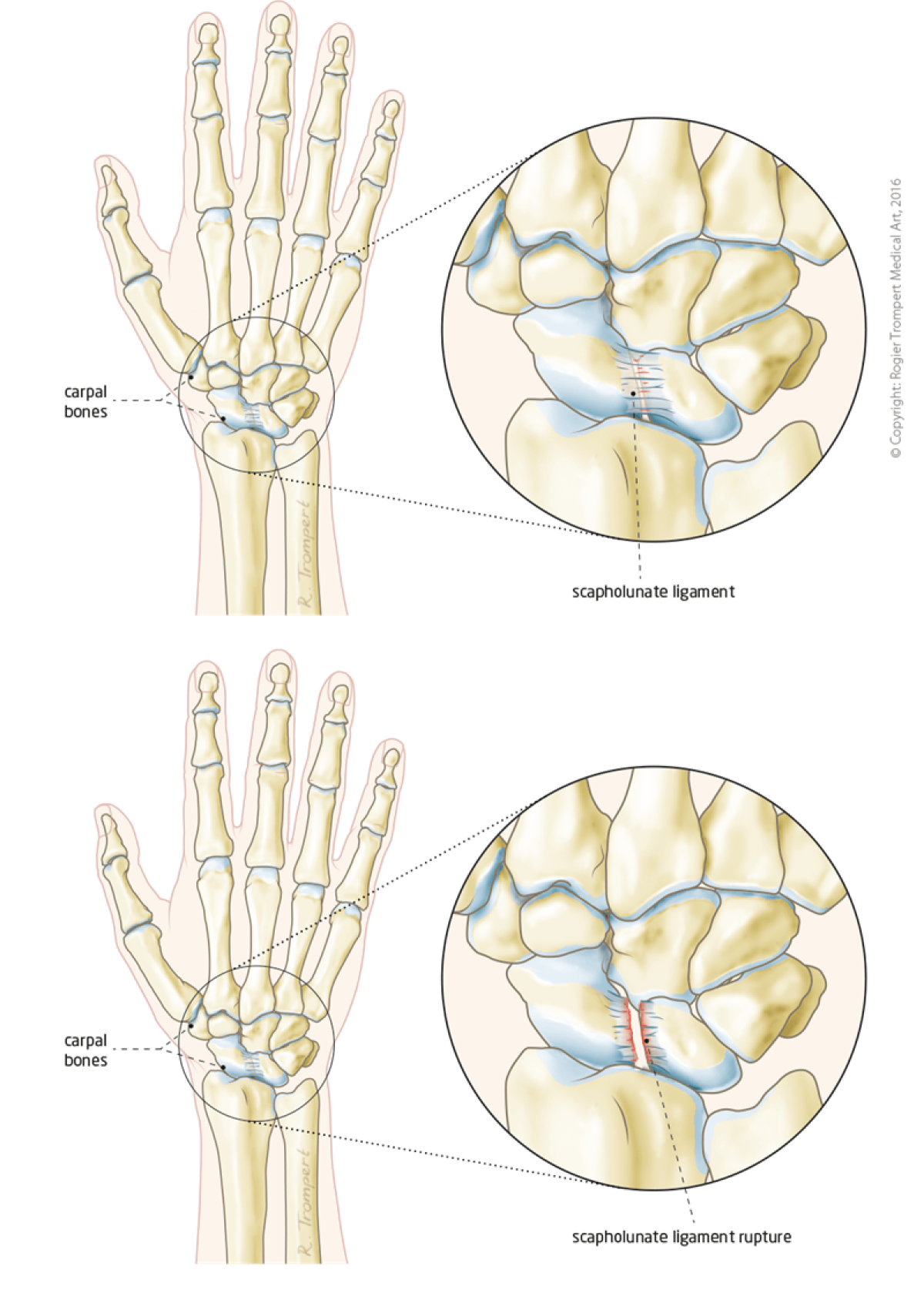 Scapholunate Ligament Injury Grip Hand Wrist Surgery